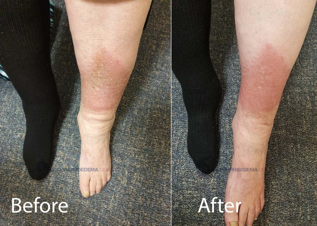 Can chronic swelling be treated? - LK Lymphoedema Centre