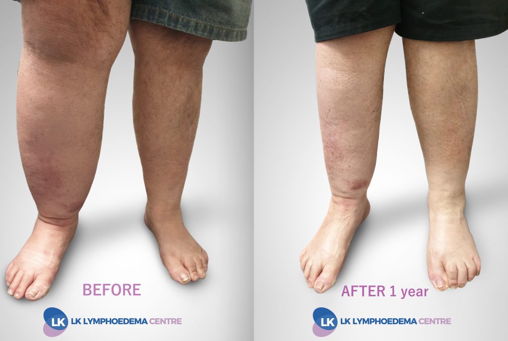 Lymphoedema: Potential for Change - LK Lymphoedema Centre